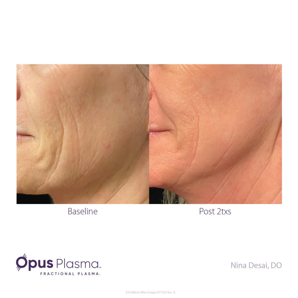 Opus Plasma Treatment - Rejuvenate Austin - Austin’s Premier Medspa